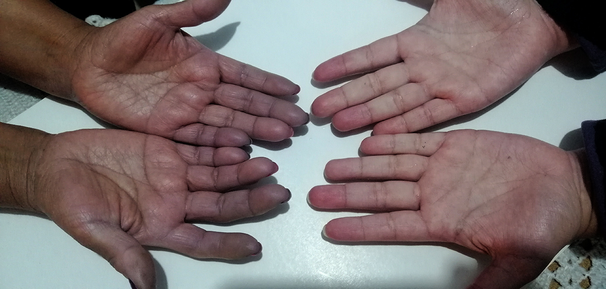 La esclerodermia, mi compañera invisible - La Barra Espaciadora